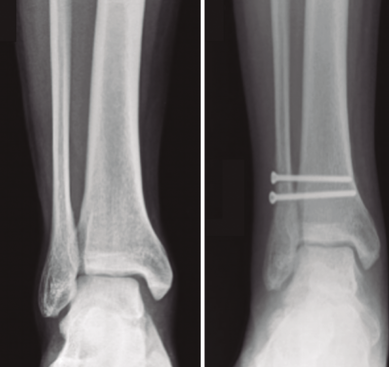 Rayos X o Radiografía de Tobillo AP con Estrés - Vizua